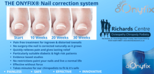 Onyfix Nail Correction System - The Richards Centre
